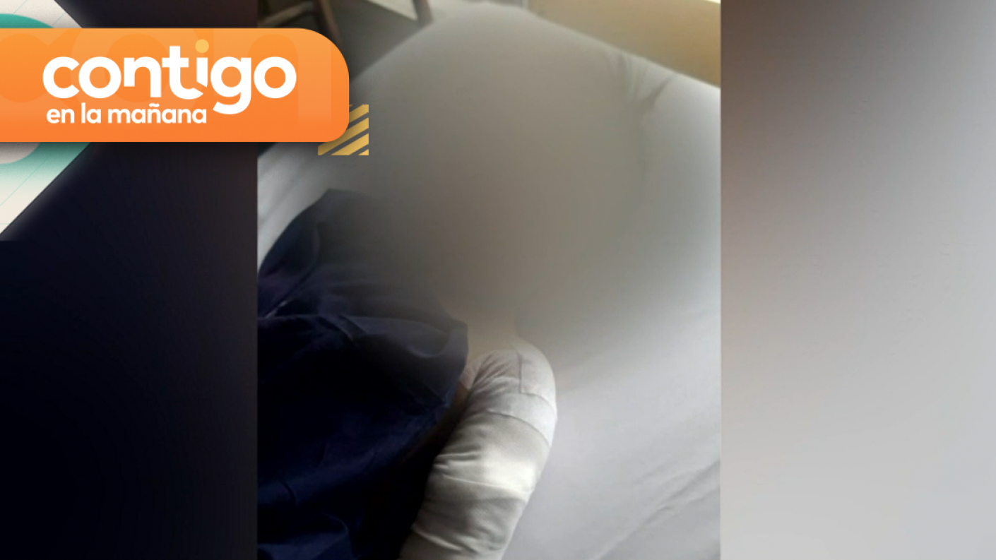 Niño de 3 años casi pierde el brazo tras se atacado por el perro de un vecino - Chilevisión